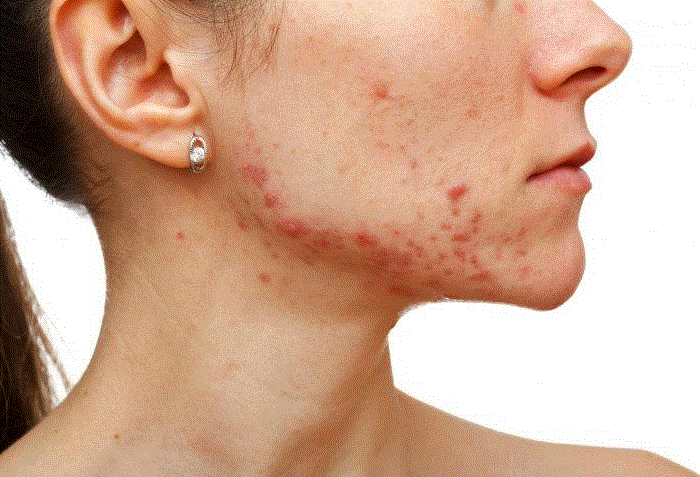 El acné vulgar es el que más afecta en la adolescencia | Es Chic